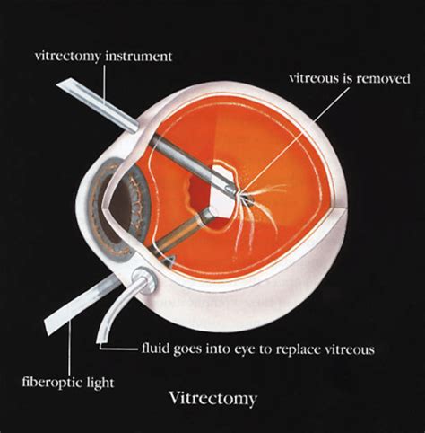 Vitreous Humor Detachment