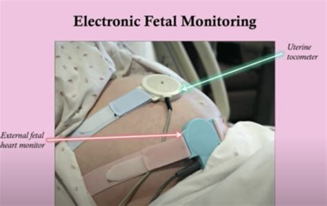Fetal Heart Monitoring Flashcards Quizlet