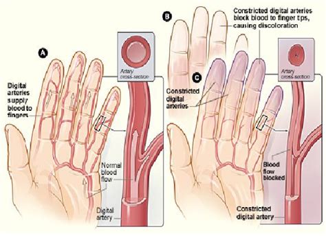 Datina TV Alergia La Frig Simptome Cauze Diagnostic Tratament