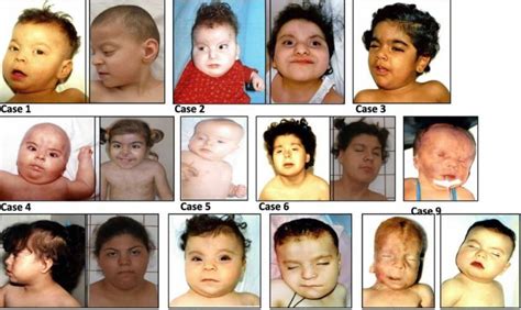 Learn About Pallister Killian Mosaic Syndrome Causes Syndrome