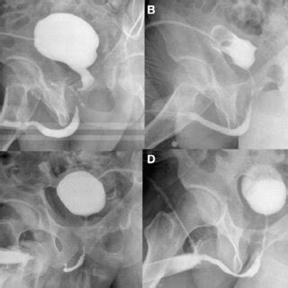 Serial Retrograde Urethrograms In A Man Aged 24 Years A Posterior Download Scientific