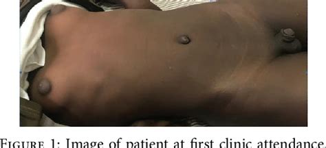 Figure 1 From Challenges In Management Of Ovotesticular Differences In