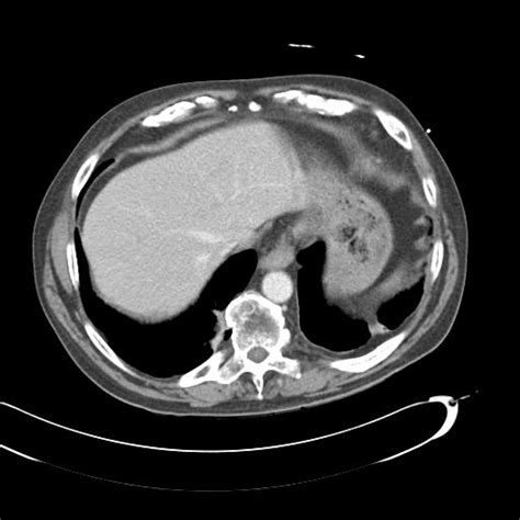 Radiopaedia Case Gluteal Hematoma And Lumbar Transverse Fracture In