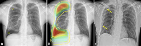 Ai Applications For Thoracic Imaging Considerations For Best Practice Radiology