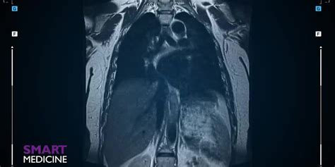 Smart Medicine Lung Cancer