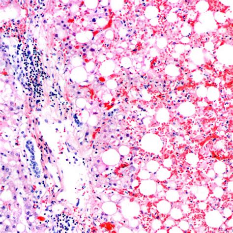 Herpes Simplex Virus Basicmedical Key