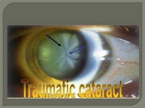 Metabolic And Complicated Cataract Pptx