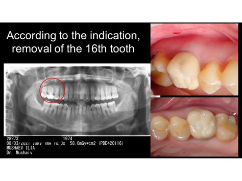 Clinical Case Atraumatic Extraction Of The 16th Tooth With An