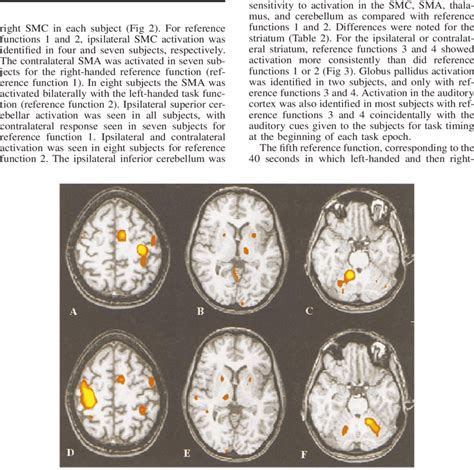 A F Functional MR Images Comparing Activation Detected By Reference Download Scientific