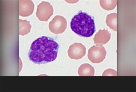 Mantle Cell Lymphoma Diagnosis And Differentiation