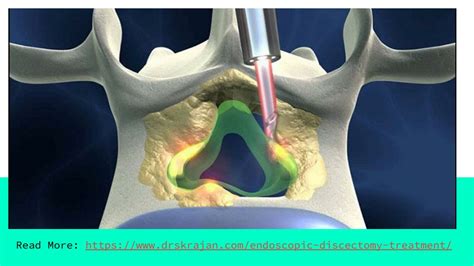 Ppt Endoscopic Discectomy Surgeon In Gurgaon Powerpoint Presentation Id11913895