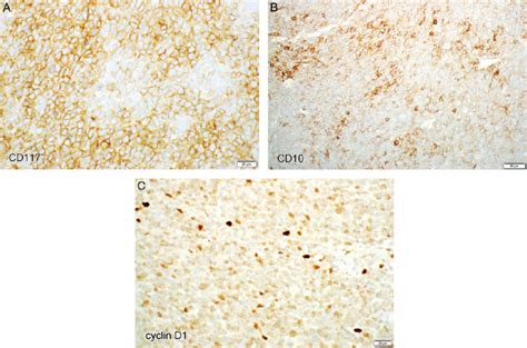 Immunohistochemical Findings Of Metastatic Sarcoma In The Lung The