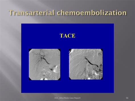 Hepatocellular Carcinoma Ppt Download