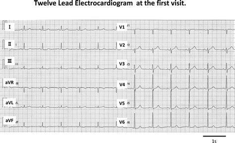 Electrocardiogram ECG At The First Visit The ECG Showed A Sinus Download Scientific Diagram