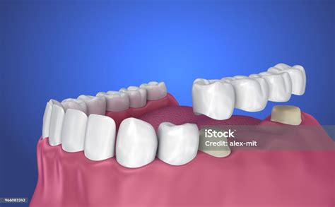 치아는 고정된 브릿지 임 플 란 트와 크라운을 지원 의학적으로 정확한 3d 그림 건강관리와 의술에 대한 스톡 사진 및 기타