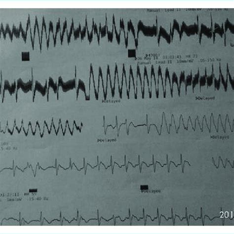 On Presentation Electrocardiogram Ecg Showing Polymorphic