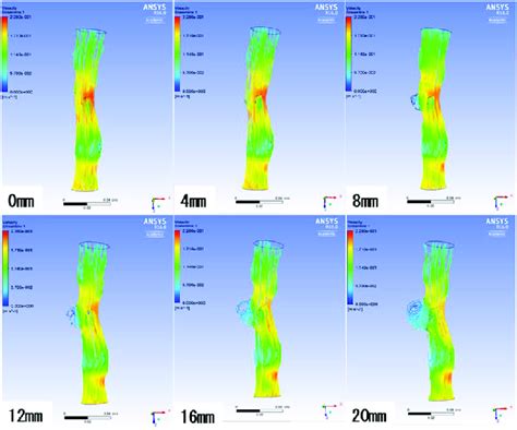 Flow Velocity Distribution As The Aneurysm Grows A Vortex Develops