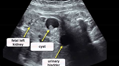Ovarian Teratoma Ultrasound