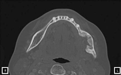 The Tumor Of The Left Mandibular Angle In Ct Scan Irregular Loss In
