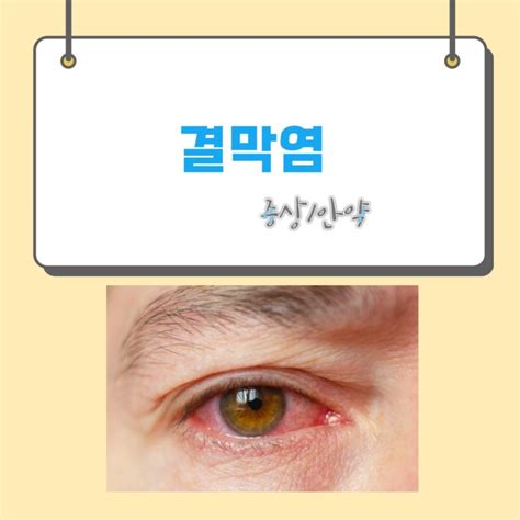 물놀이 눈병 주의 유행성 결막염 증상 치료 안약 전염은 네이버 블로그