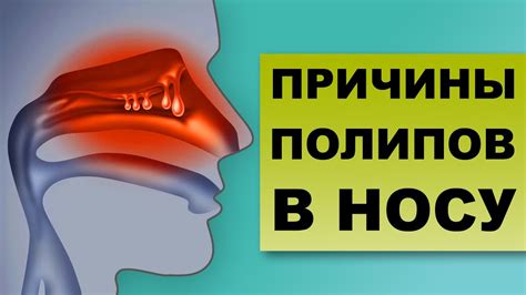 ПОЛИПЫ В НОСУ Причины заболевания Youtube