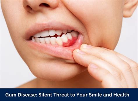 Gum Disease Silent Threat To Your Smile And Health