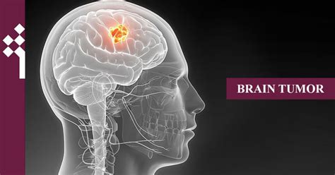Understanding Different Types Of Benign Brain Tumours Best Hospital