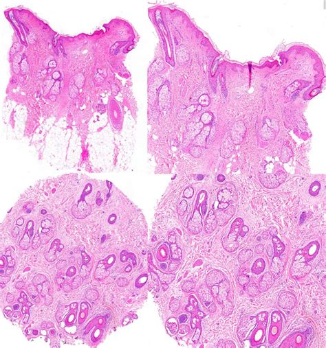 Androgenetic Alopecia A And B Vertical Sections Miniaturization