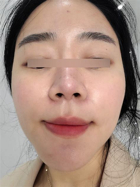 강남 피부과물광주사스킨부스터 릴리이드m맞고 온 실제후기 물광주사 가격붓기통증효과 등 리쥬란 힐러와 차이사진o 네이버 블로그