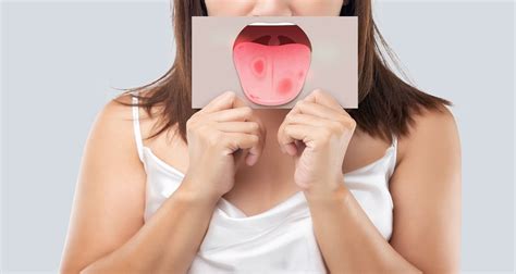 Cidentist Best Treatment For Transient Lingual Papillitis