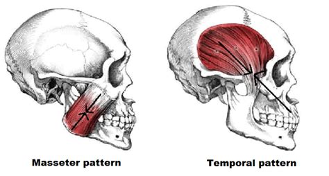 Jaws Masseter Pattern Vs Temporal Pattern Main Forum Correction