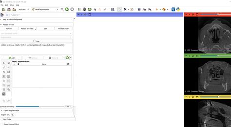 Dentalsegmentator Version Of 2024 04 22 Fails To Load Segmentation Result Support 3d Slicer