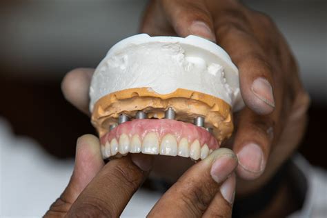 Zygomatic Dental Implants NuArch By Dr Sal Dental Implant Center