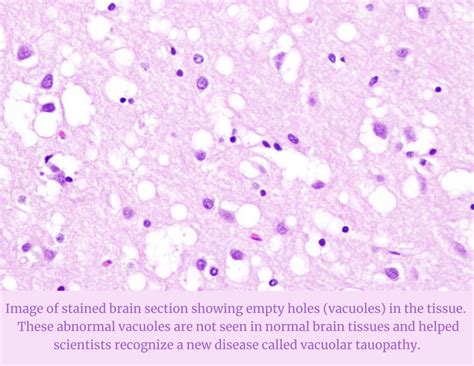 Upenn Researchers Discover New Rare Cause Of Dementia Penn Memory Center