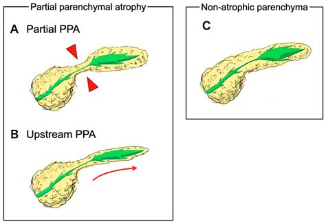Parenchymal Atrophy