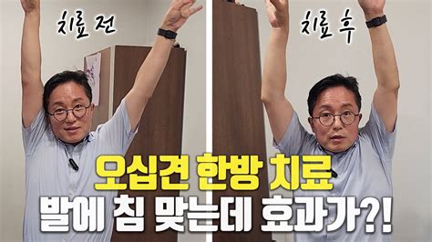 어깨가 아픈데 다리에 침을 놓는다 Youtube