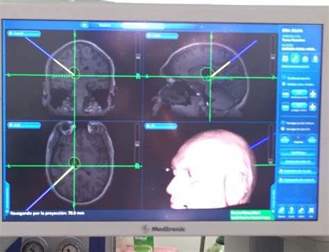 Lo Que Se Debe Saber Del Infarto Agudo De Miocardio La Misericordia