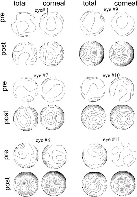 Total And Corneal Wave Aberration Contour Plots Thirdorder And Higher Download Scientific