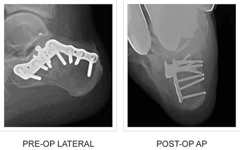 Sinus Tarsi Plate Ortho Providers