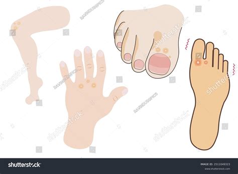 Hpv Related Over 6 Royalty Free Licensable Stock Illustrations