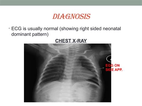 Cyanotic Congenital Heart Diseases In Pediatrics Ppt
