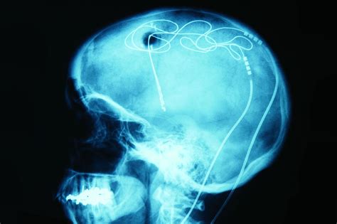 How Tiny Electrodes In The Brain Could Treat Parkinsons Ocd And Even
