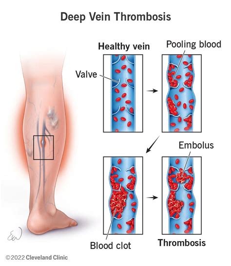 Understanding Deep Vein Thrombosis Ask The Nurse Expert