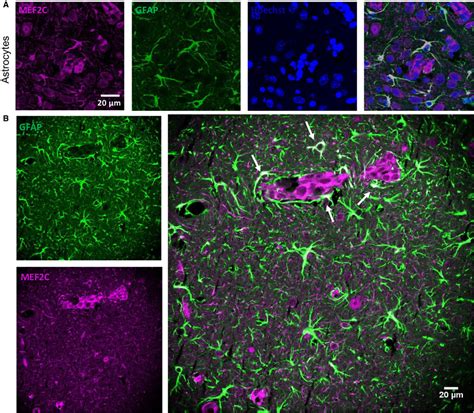Myocyte Enhancer Factor 2c Mef2c Expression In The Peritumoral