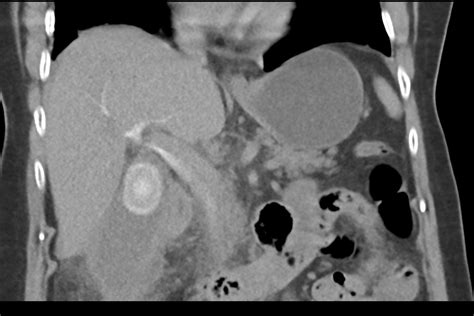 Radiopaedia Case Cholecystitis Obstructive Choledocholitiasis Ct