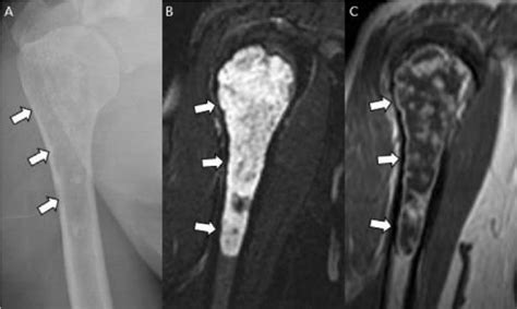 Figure 4 From Classification Of Chondrosarcoma From Characteristic To Challenging Imaging