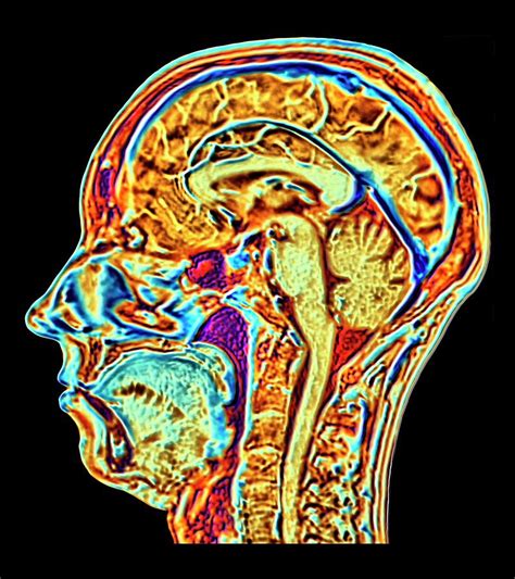Normal Brain Mri Images