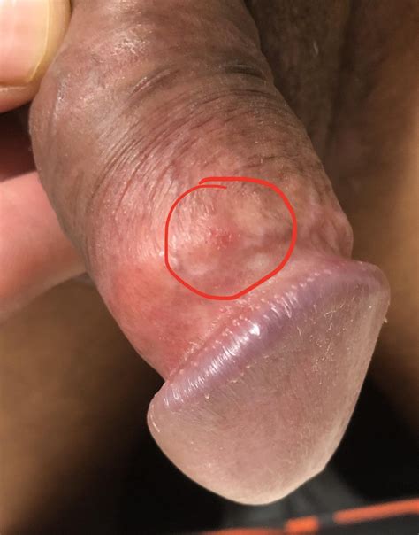 Which Stds “could” You Have Without Ever Even Knowing Symptomless As