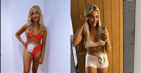 confident bikini babe holly shows off stoma bag after having colon and