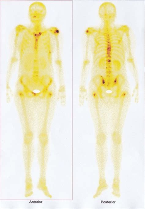 Bone Scan Multiple Bone Metastases Download Scientific Diagram